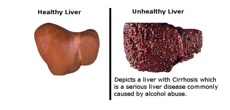 Gejala penyakit liver, penyebab dan cara mengobatinya - Uretaania Blogs