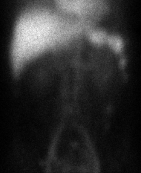 NuCleaR MuNkeE: Liver Spleen Scan Using Denatured Red Blood Cells