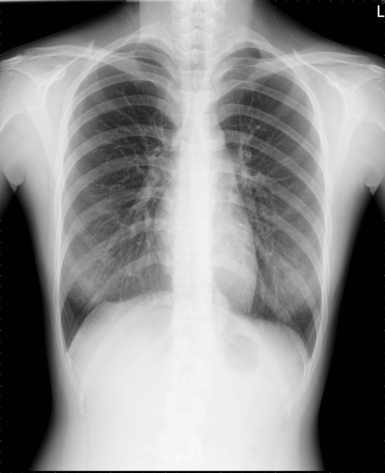 CXR 胸部x光判讀 pleural mass