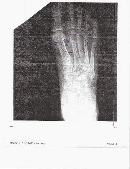 Foot and Ankle Problems By Dr. Richard Blake: 2nd Metatarsal Fracture ...