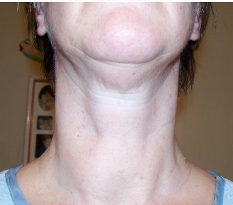 Reproductive Health and Fetal: Thyroid gland is a small butterfly ...