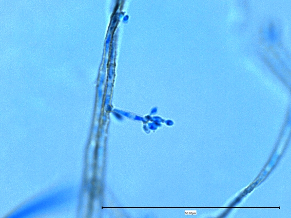 Fun With Microbiology (What's Buggin' You?): Fonsecaea pedrosoi/monophora