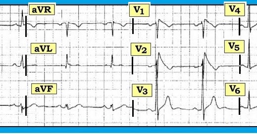 ECG Interpretation: ECG Interpretation Review #50 (Syncope - STEMI - MI ...