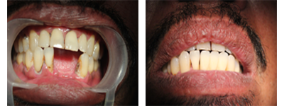 » Front teeth Replacement using Dental implants