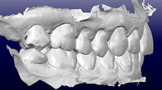 RiteBite Orthodontics: Invisalign Outcome Simulator To Use Digital ...