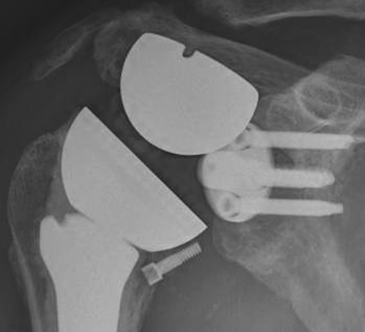 UW Shoulder and Elbow Academy: Reverse total shoulder - dissociation of ...