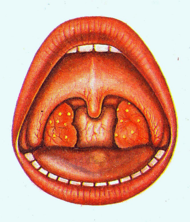 Angina ( acute tonsillitis )|Symptoms of diseases