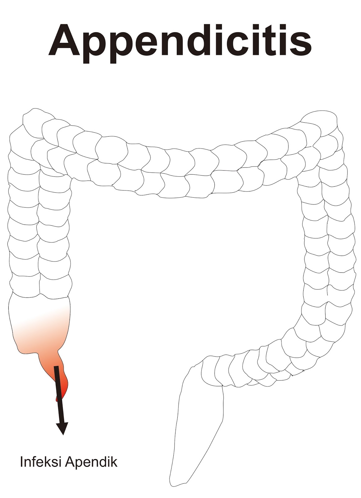 Asuhan Keperawatan (askep) Penyakit Apendisitis (usus buntu) - Share ...