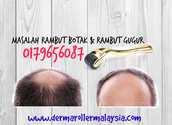 Kaedah Rawatan Rambut Gugur Dengan Dermaroller - nanieybarnieylurviey
