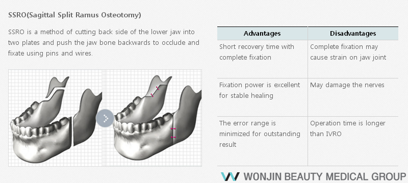 Korea Two Jaw Surgery Wonjin Beauty Medical Group - Jutting Jaw ...