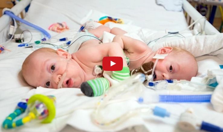 Rare Conjoined Twins Successfully Separated by Nemours Surgeons - New Hope