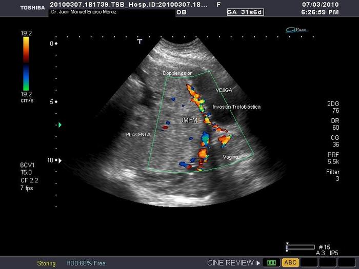 ACRETISMO PLACENTARIO | "Obstetricia I"