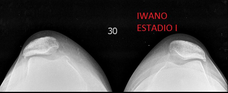 O R T O C R I T I C A: Inestabilidad rotuliana bilateral
