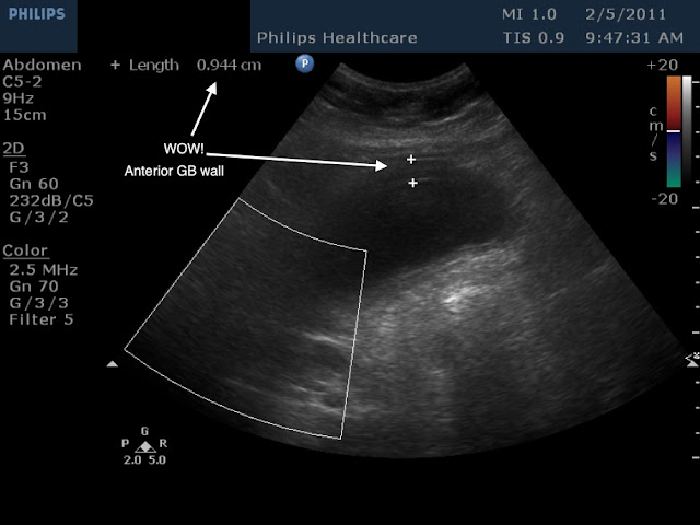 Acute Cholecystitis ~ Ultrasound Cases Info