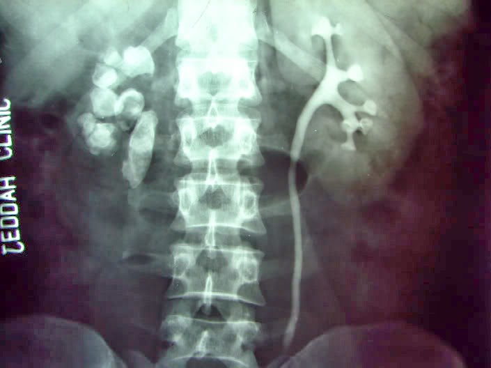 Chỉ định Chống chỉ định của chụp niệu đồ tĩnh mạch - UIV | Bác Sĩ Đa Khoa