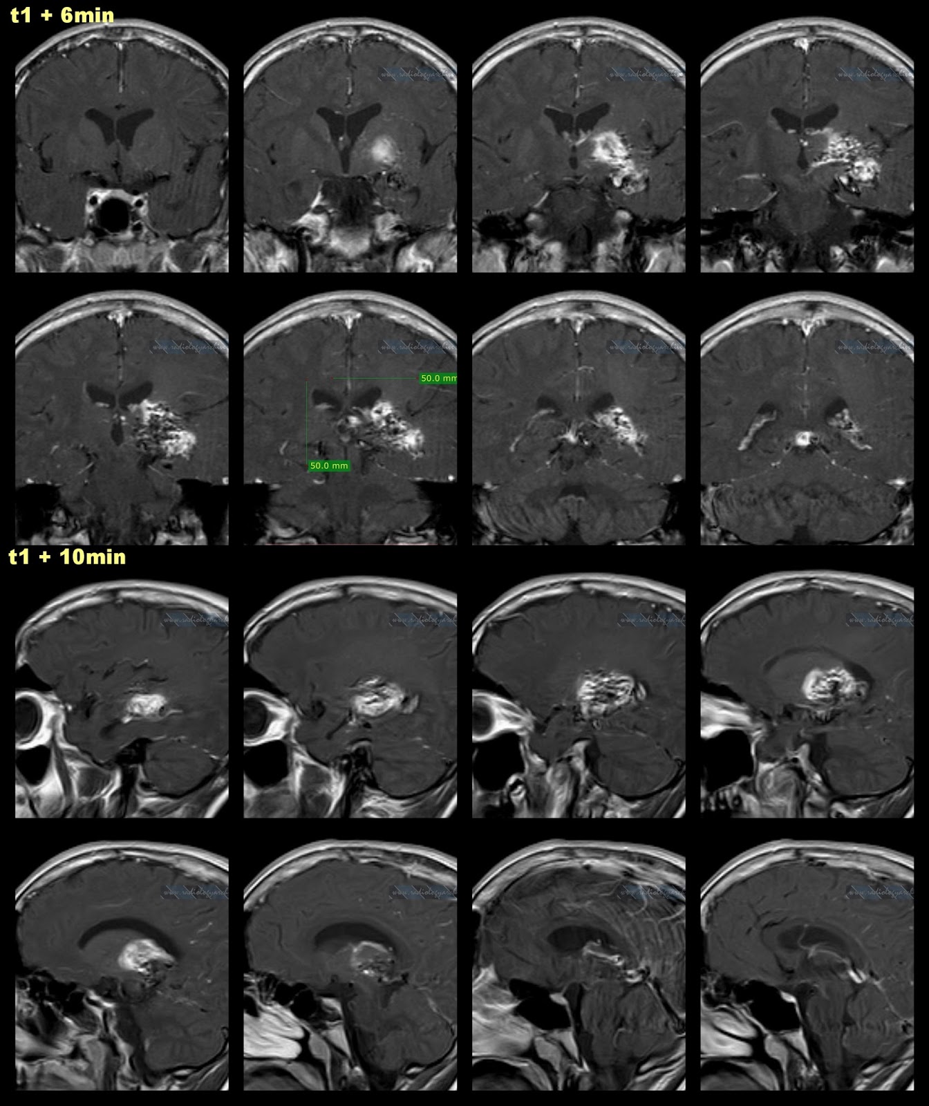 Radiology Archives: Αρτηριοφλεβώδης Δυσπλασία Εγκεφάλου (Spetzler ...