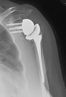 UW Shoulder and Elbow Academy: Revision of anatomic arthroplasty to ...