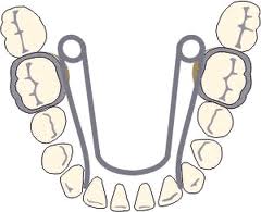 DISEÑAR APARATOLOGIA: QUAD HELIX