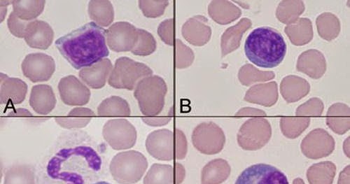 Medical Laboratory and Biomedical Science: Lymphocytes Variation