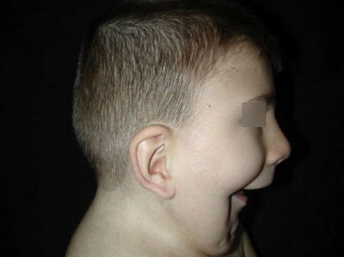 Klippel-Feil Syndrome Pictures | Medical Pictures and Images - (2023 ...