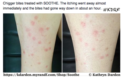 Skin, Health & Beauty: ASK KATHRYN: What Works on Chigger Bites?