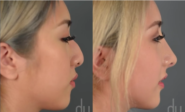 Asian Rhinoplasty Procedure | Korean Nose Job Experience | Kpop Plastic ...