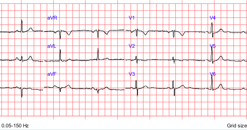 Dr. Smith's ECG Blog: Chest pain and a non-diagnostic ECG. No worries ...