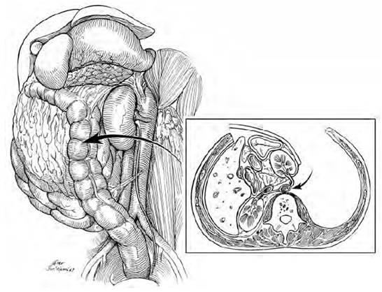 CEDERA AORTA ABDOMEN | == Inspirasi Sejarah Kang Heri
