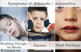 ENFERMERÍA A UN CLIC : ADENOIDITIS