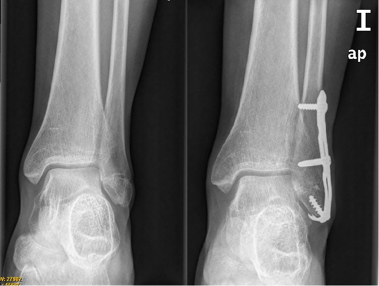 Fanáticos del pie: ATLAS DE PATOLOGIA DEL PIE: PSEUDOARTROSIS MALEOLO ...