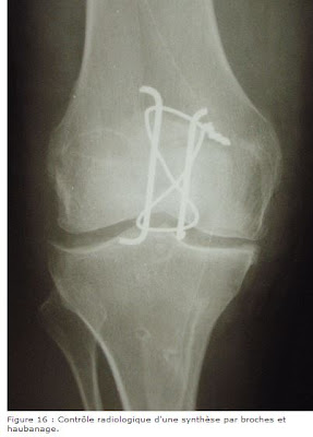 Un médecin du sport vous informe: fractures de la rotule