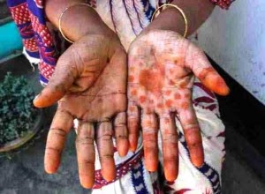 Primeros Auxilios: ¿ Cómo manejamos una intoxicación?