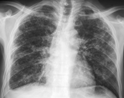 MEDICINA: INTERPRETACIÓN DE LAS RADIOGRAFÍAS DE TÓRAX EN URGENCIAS