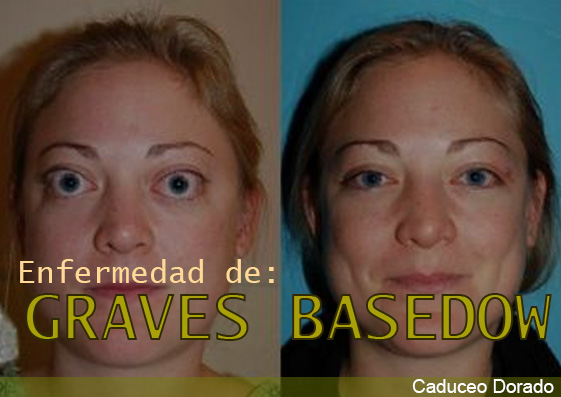 Caduceo Dorado: ENFERMEDAD DE GRAVES BASEDOW