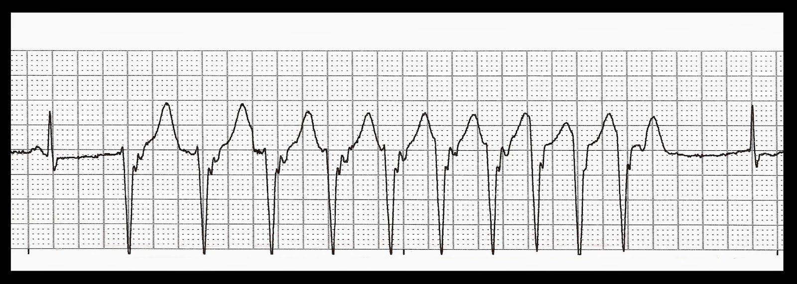 Float Nurse: EKG Rhythm Quiz 269