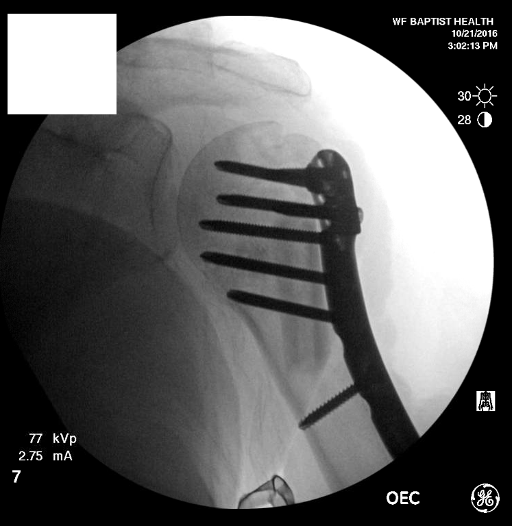 Shoulder and Elbow Surgery: Proximal humerus fracture dislocation. How ...