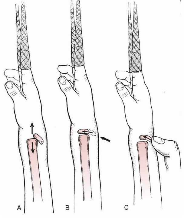 Winstonbone: Pediatric fracture of distal radius and ulnar (Physeal ...