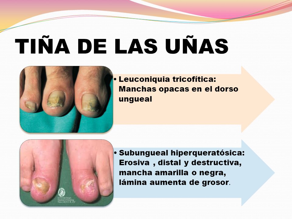 Como Se Produce La Tiña ,Causas y Tratamiento