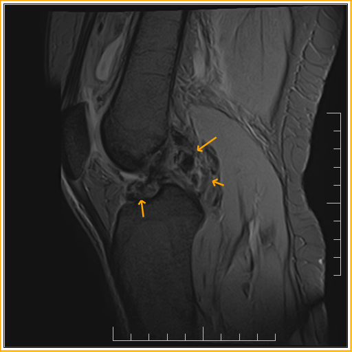 Pigmented villonodular synovitis : MRI - Sumer's Radiology Blog