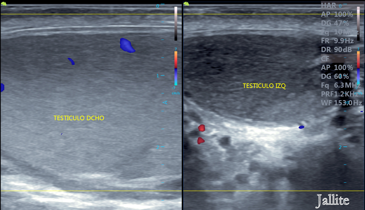 Torsión Testicular Crónica con Atrofia Testicular
