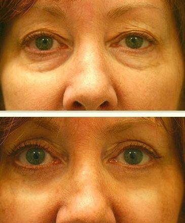 Non-Invasive Facelifts And Yoga Facial Exercises: Quick Dark Eye Rings ...