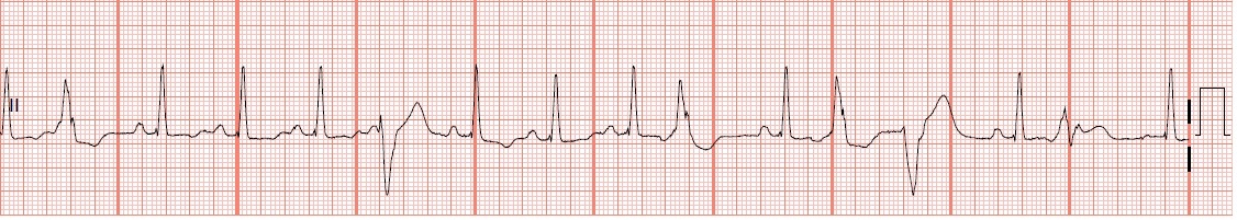 EKG Rhythm Strip Quiz 30