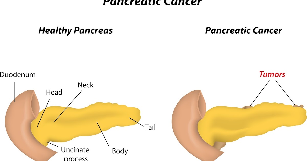 Laparoscopic Treatment : Purpose, Procedure & Recovery: Pancreatic ...