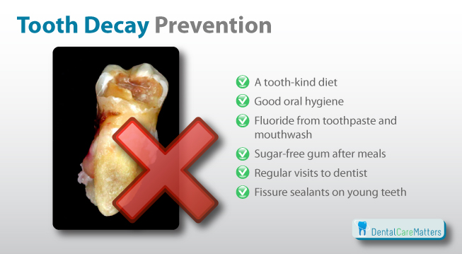 Causes And Preventions For Tooth Decay ~ Healthy Life For All