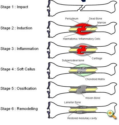 Leads Speed: Patah tulang? Medis atau Non Medis..
