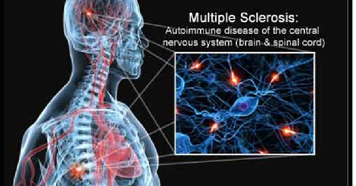 Elementi di base sulla sclerosi multipla / Basic facts about multiple ...
