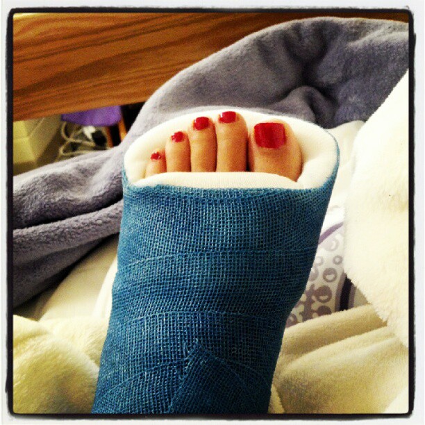 Casts and Toes: Random Assortment of Cast Pics