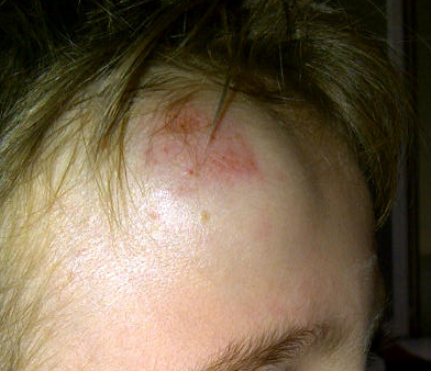 Primeros Auxilios Lifeguard: Traumatismos