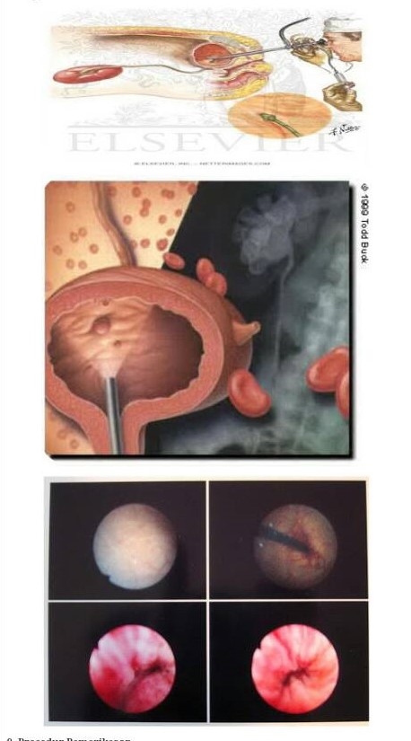 azizah nur: Retrograde Pyelography