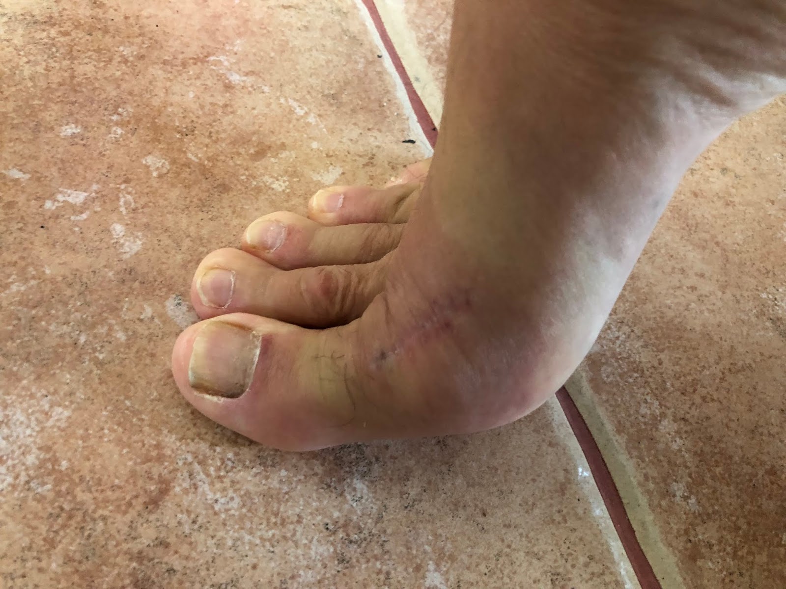 Foot and Ankle Problems By Dr. Richard Blake: Cheilectomy: Exercise ...